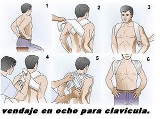 FRACTURA DE CLAV CULA